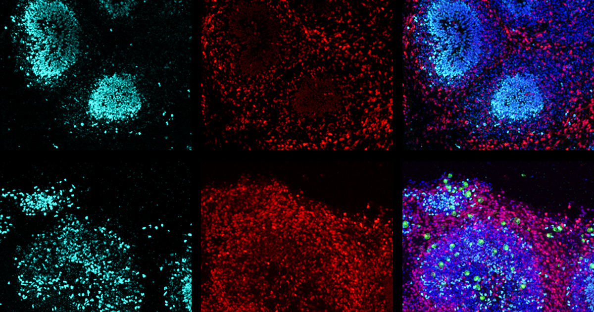 RNU4-2 gene; autism screening in Kenya; Rett syndrome gene therapy ...