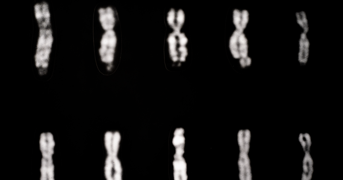 Understanding fragile X syndrome | The Transmitter: Neuroscience ...