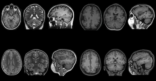 Impaired molecular ‘chaperone’ accompanies multiple brain changes, conditions | The Transmitter ...