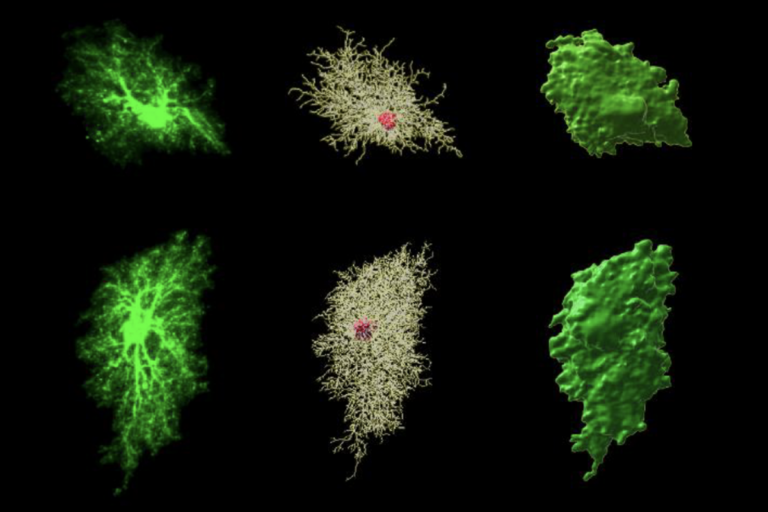 Alzheimer’s disease and autism; and more | The Transmitter ...